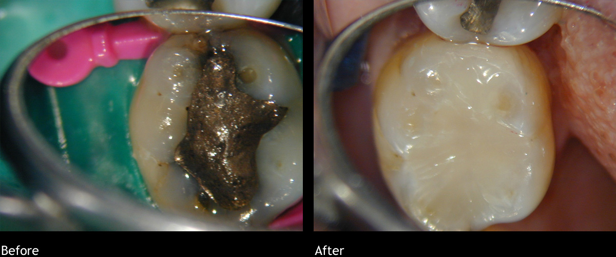 Amalgam Replacement - Colonnade Dental - Dr. Vincent How - Dentist ...